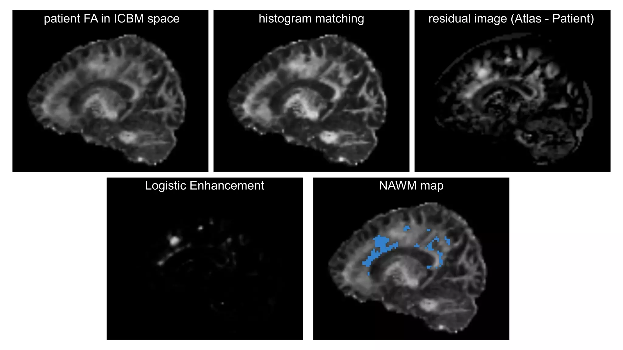 Multimodal MRI statistical segmentation of normal appearing white matter lesions in multiple ...