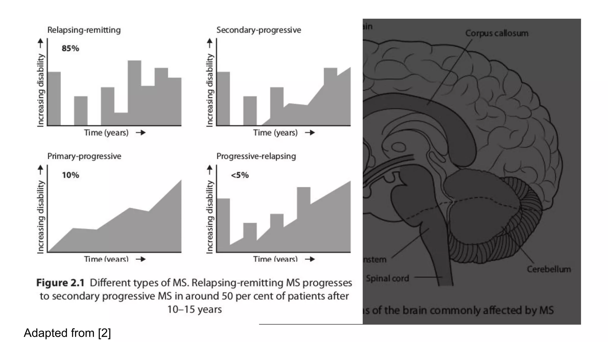 Multimodal MRI statistical segmentation of normal appearing white matter lesions in multiple ...