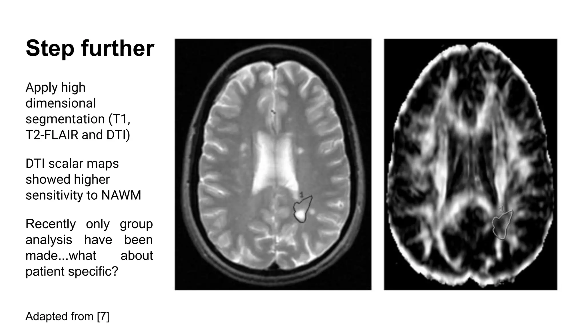 Multimodal MRI statistical segmentation of normal appearing white matter lesions in multiple ...