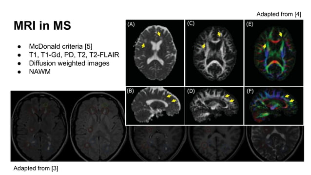 Multimodal MRI statistical segmentation of normal appearing white matter lesions in multiple ...