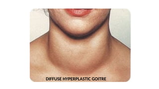 multinodular Goiter By Prasad Institute. | PPTX