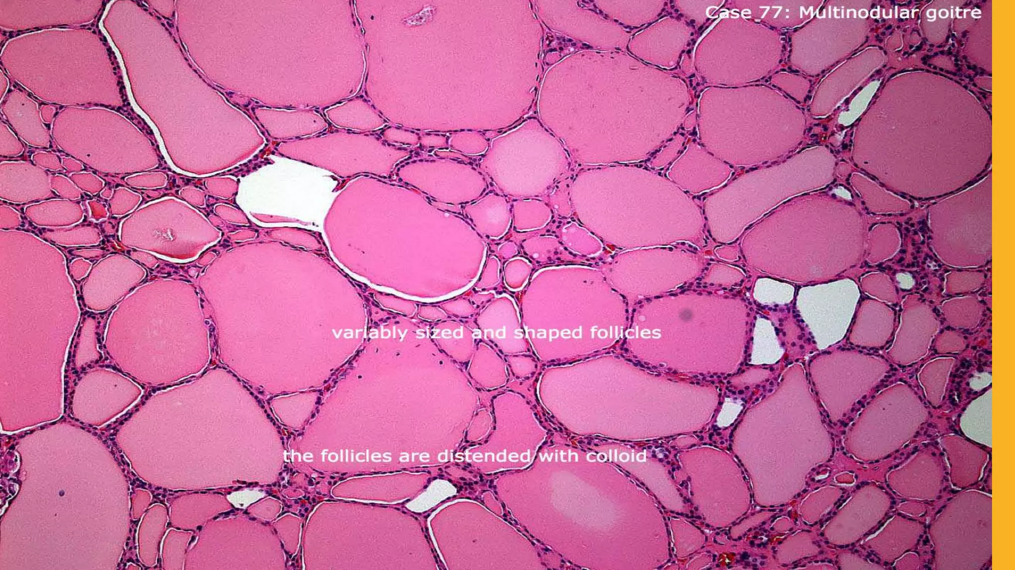 Multi nodular goitre (MNG) | PPTX