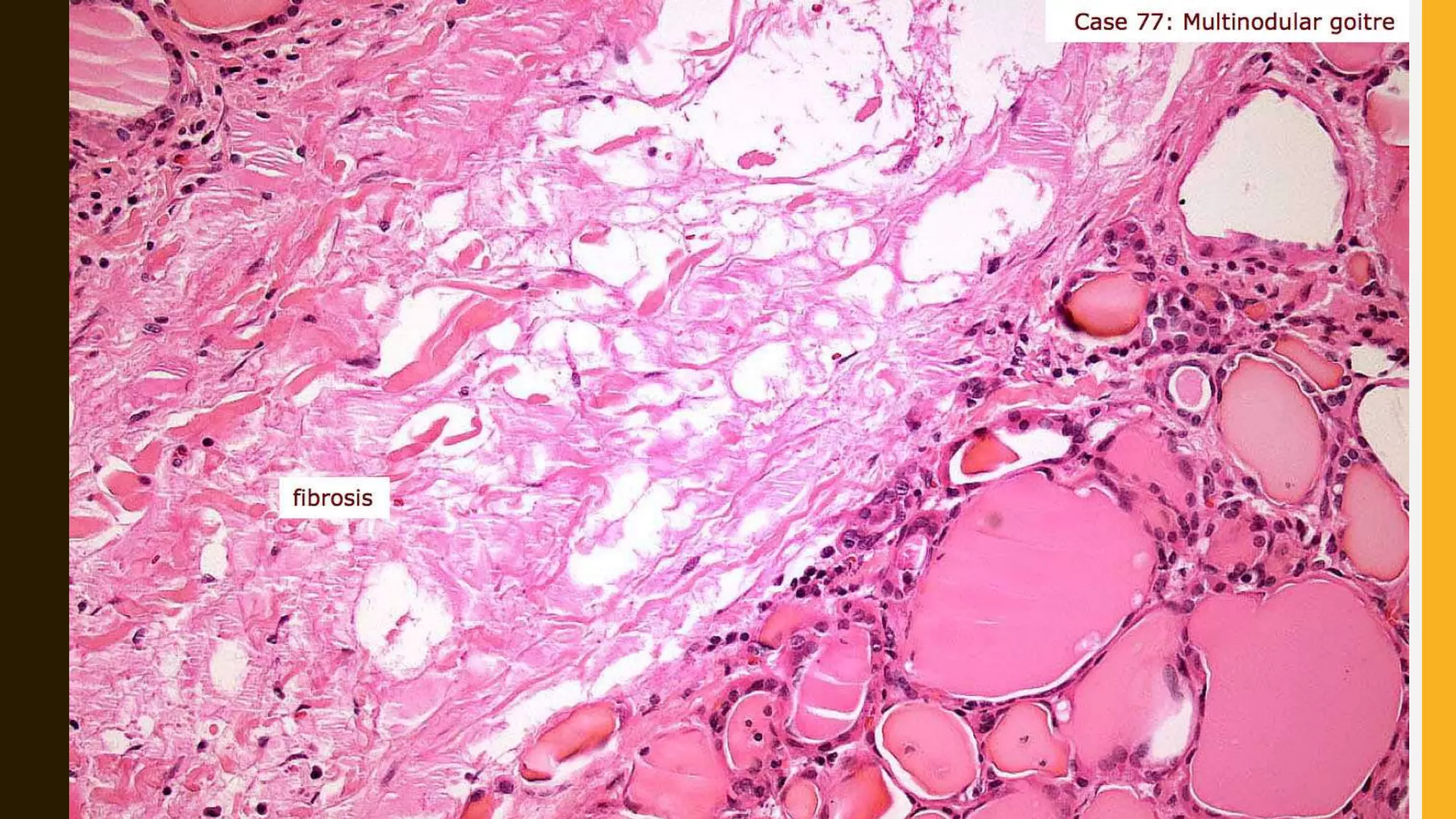 Multi nodular goitre (MNG) | PPTX