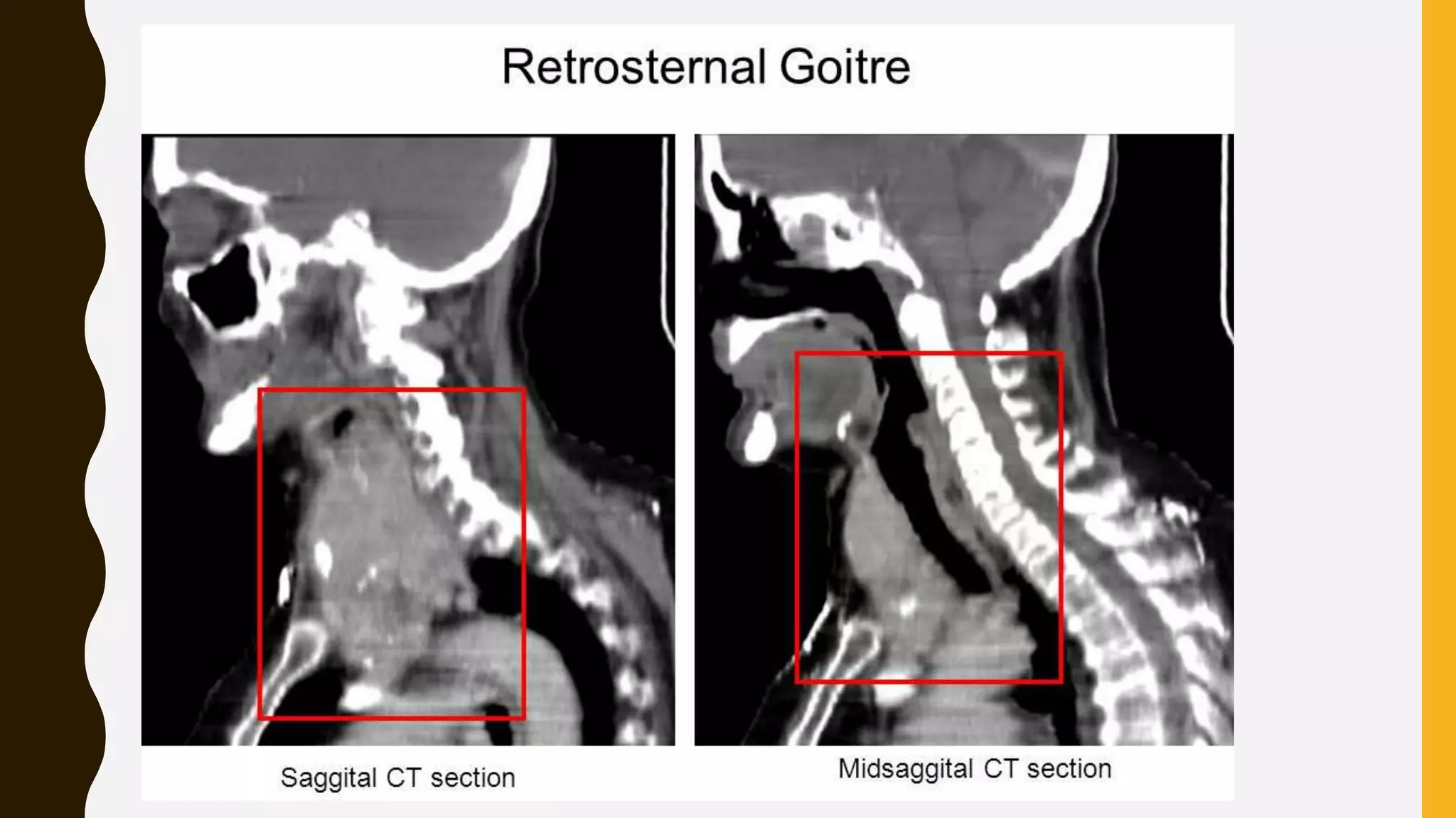 Multi nodular goitre (MNG) | PPTX