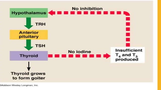 Multi nodular goitre (MNG) | PPTX | Thyroid Disorders | Endocrine and ...