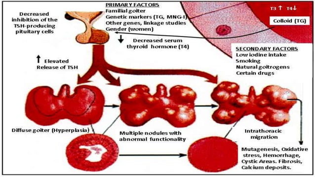 Multi nodular goitre (MNG) | PPTX | Thyroid Disorders | Endocrine and ...