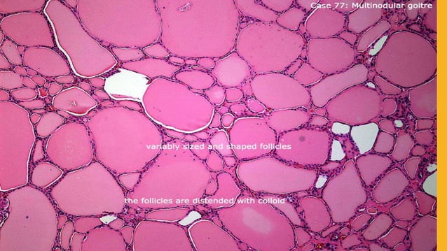 Multi nodular goitre (MNG) | PPTX | Thyroid Disorders | Endocrine and ...