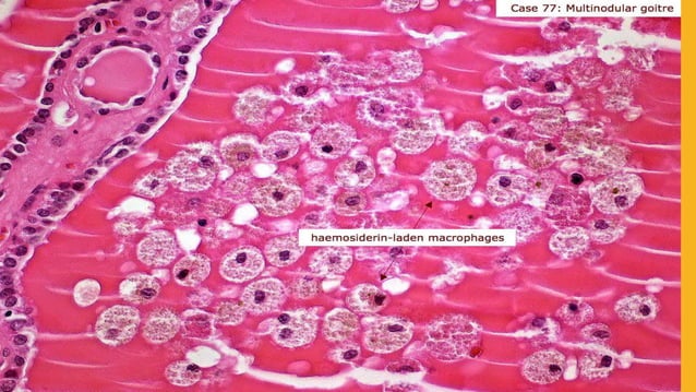 Multi nodular goitre (MNG) | PPTX | Thyroid Disorders | Endocrine and ...