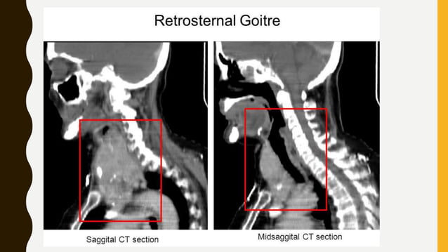 Multi nodular goitre (MNG) | PPTX | Thyroid Disorders | Endocrine and ...