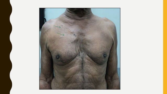 Multi nodular goitre (MNG) | PPTX | Thyroid Disorders | Endocrine and ...