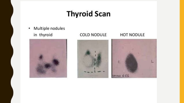 Multi nodular goitre (MNG) | PPTX | Thyroid Disorders | Endocrine and ...