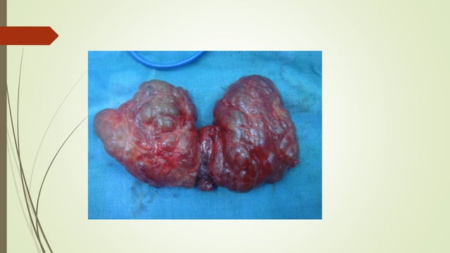 Multinodular goitre | PPTX