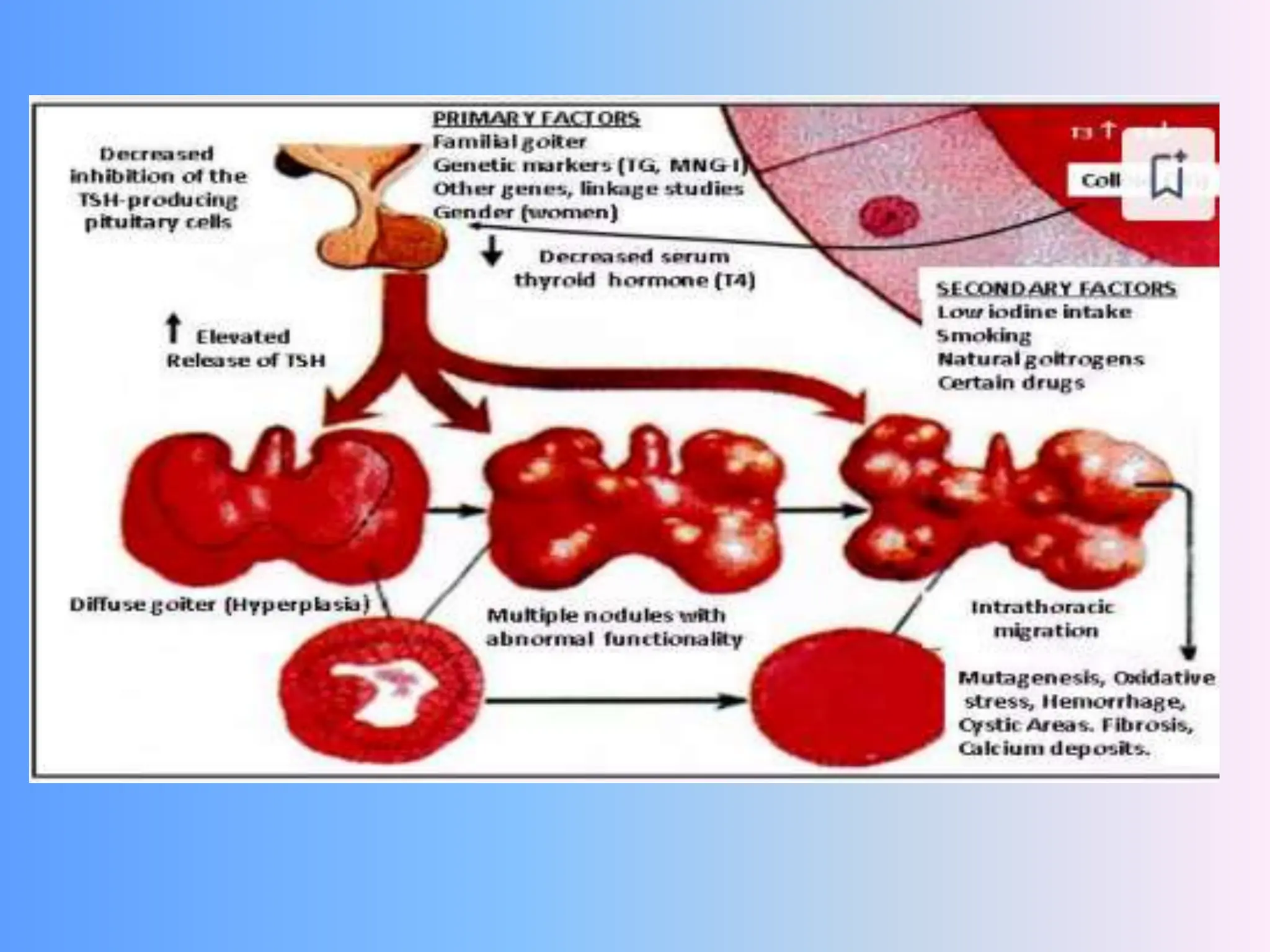 Multi Nodular Goitre MBBS 3rd year..pptx