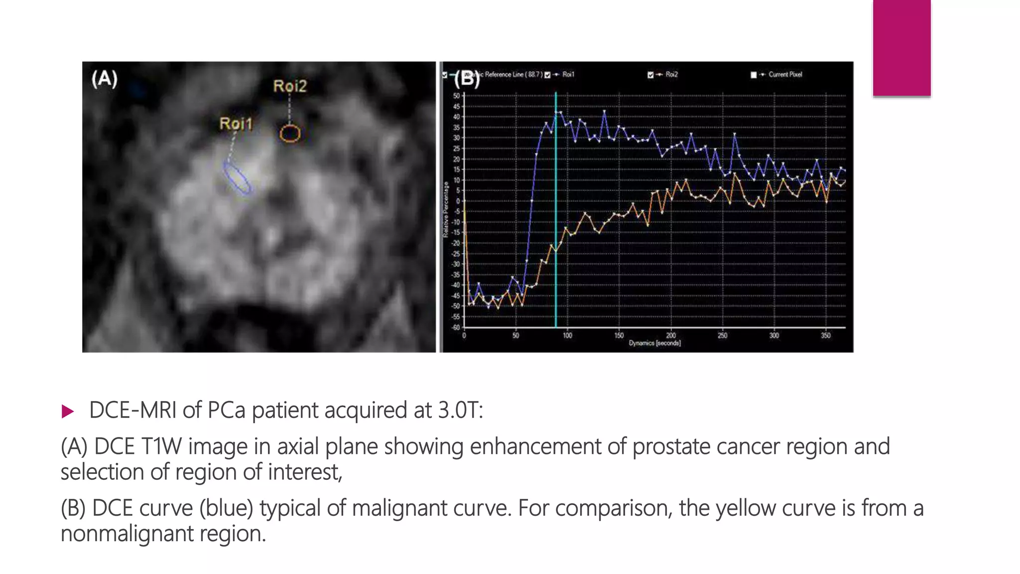 Multiparametric (mp) mri of prostate cancer | PPTX