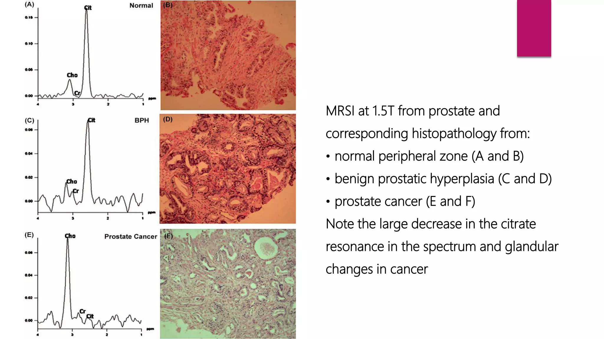 Multiparametric (mp) mri of prostate cancer | PPTX