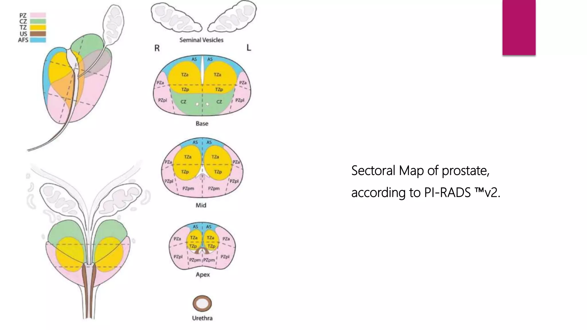 Multiparametric (mp) mri of prostate cancer | PPTX