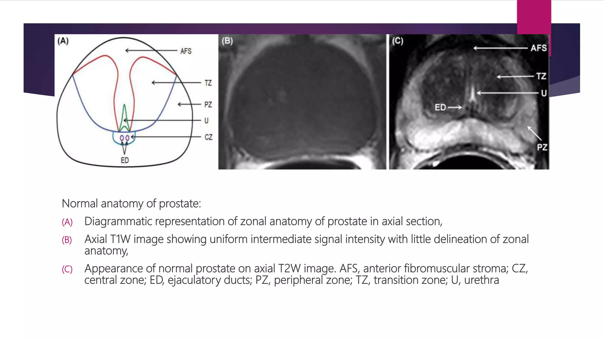 Multiparametric (mp) mri of prostate cancer | PPTX