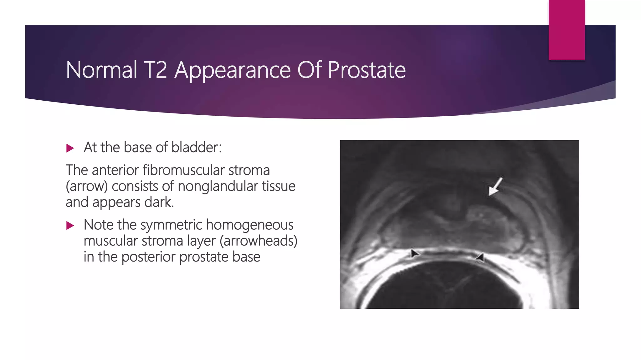 Multiparametric (mp) mri of prostate cancer | PPTX