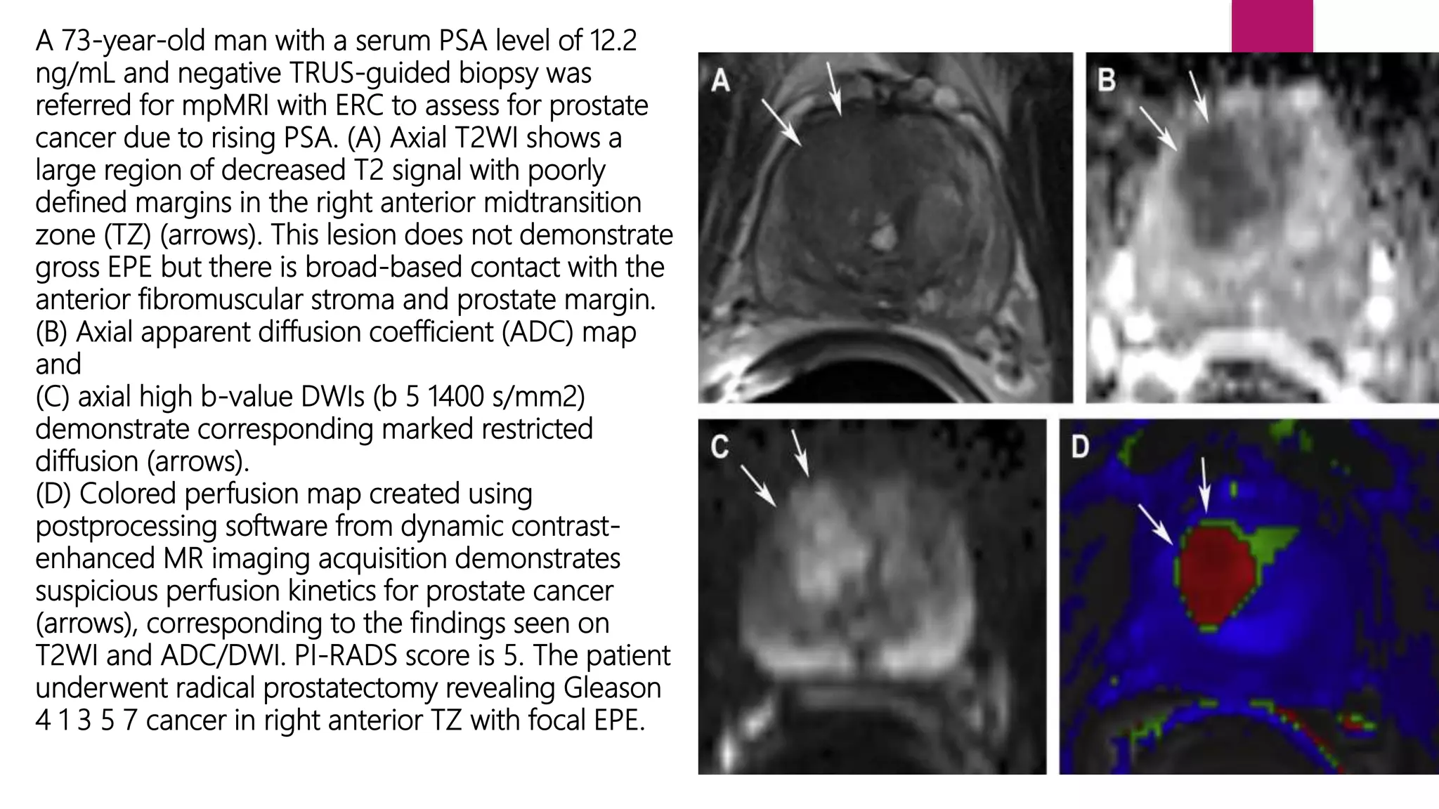 Multiparametric (mp) mri of prostate cancer | PPTX