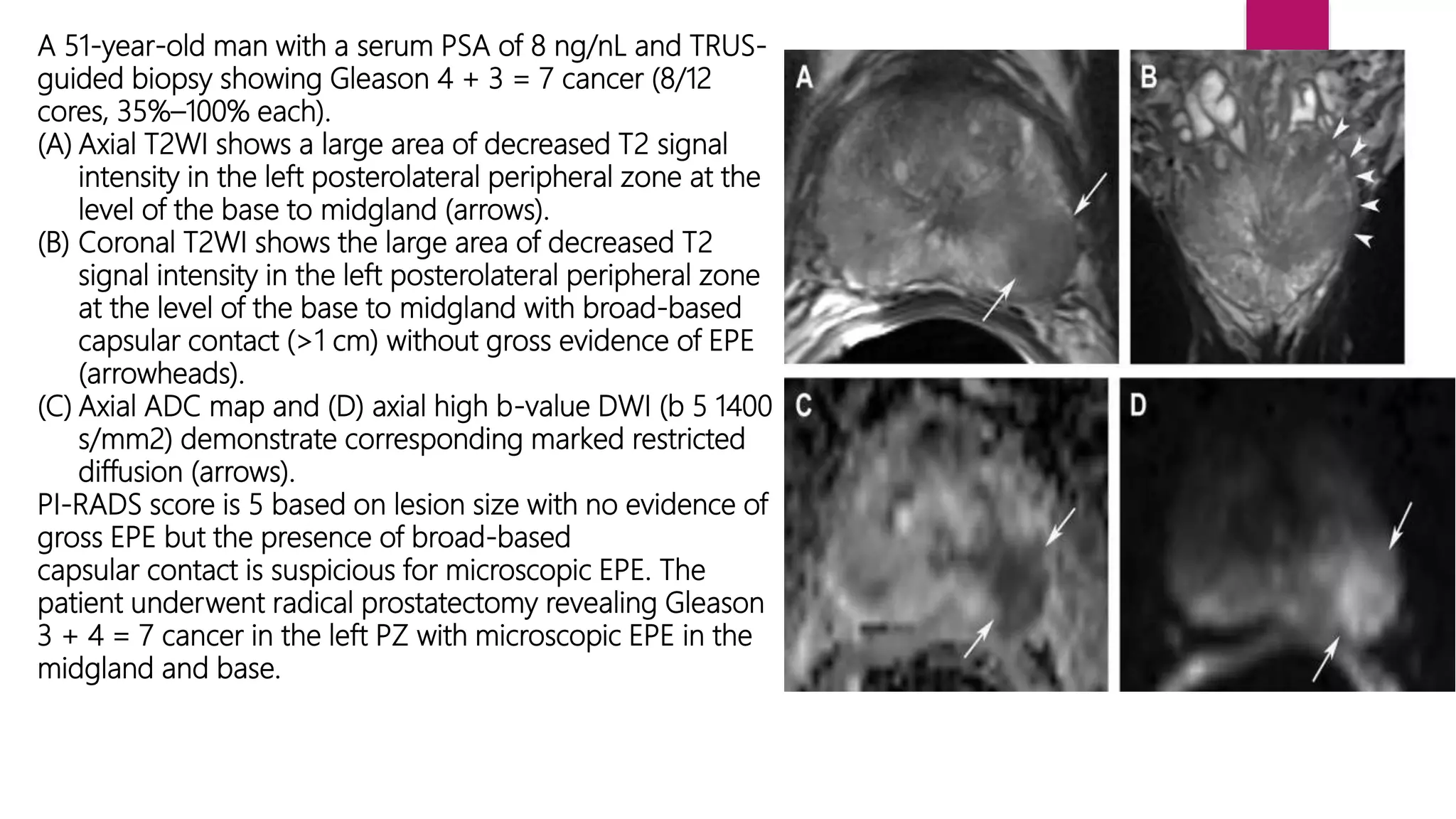 Multiparametric (mp) mri of prostate cancer | PPTX