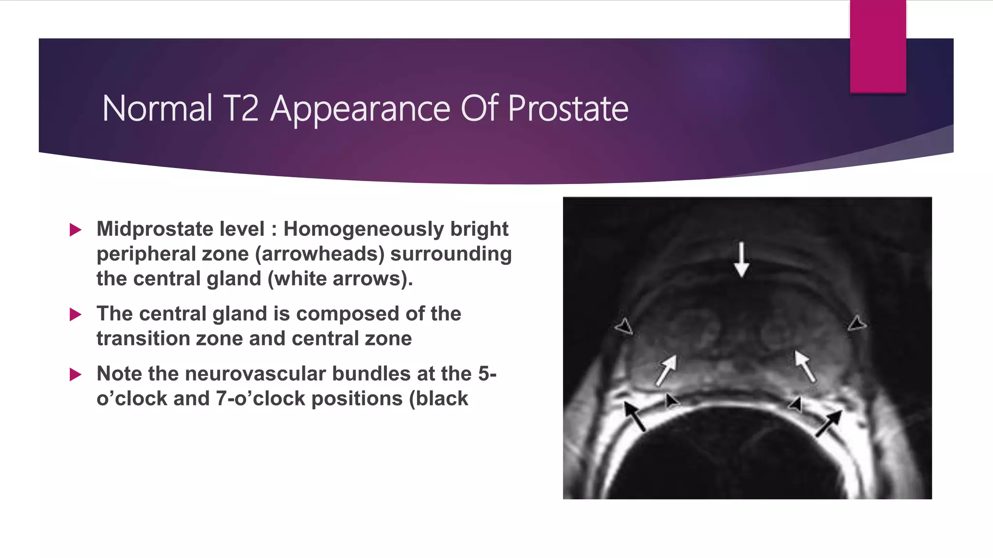 Multiparametric (mp) mri of prostate cancer | PPTX
