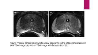 Multiparametric (mp) mri of prostate cancer | PPTX