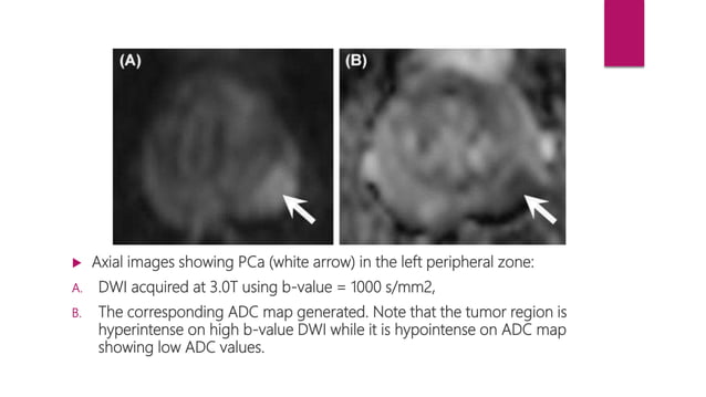 Multiparametric (mp) mri of prostate cancer | PPTX