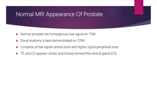 Multiparametric (mp) mri of prostate cancer | PPTX