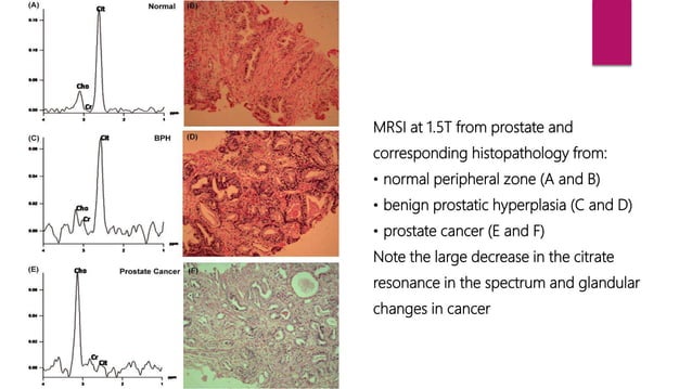 Multiparametric (mp) mri of prostate cancer | PPTX