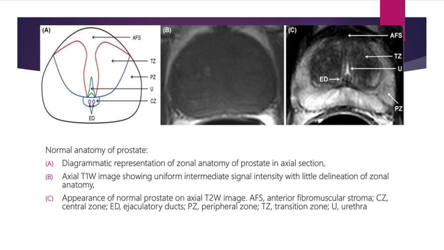 Multiparametric (mp) mri of prostate cancer | PPTX