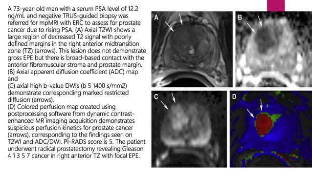 Multiparametric (mp) mri of prostate cancer | PPTX