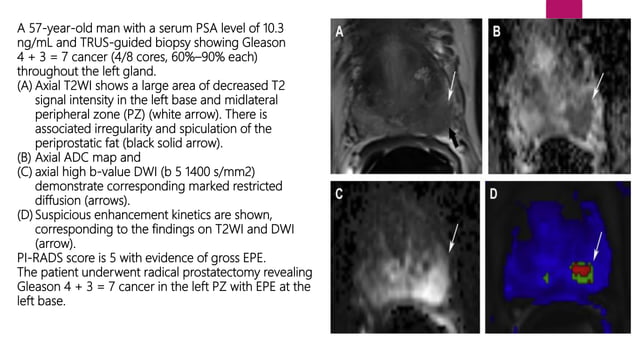 Multiparametric (mp) mri of prostate cancer | PPTX