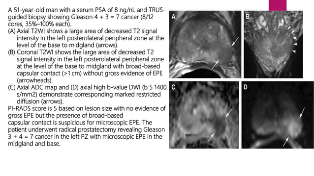 Multiparametric (mp) mri of prostate cancer | PPTX