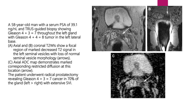 Multiparametric (mp) mri of prostate cancer | PPTX