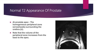 Multiparametric (mp) mri of prostate cancer | PPTX