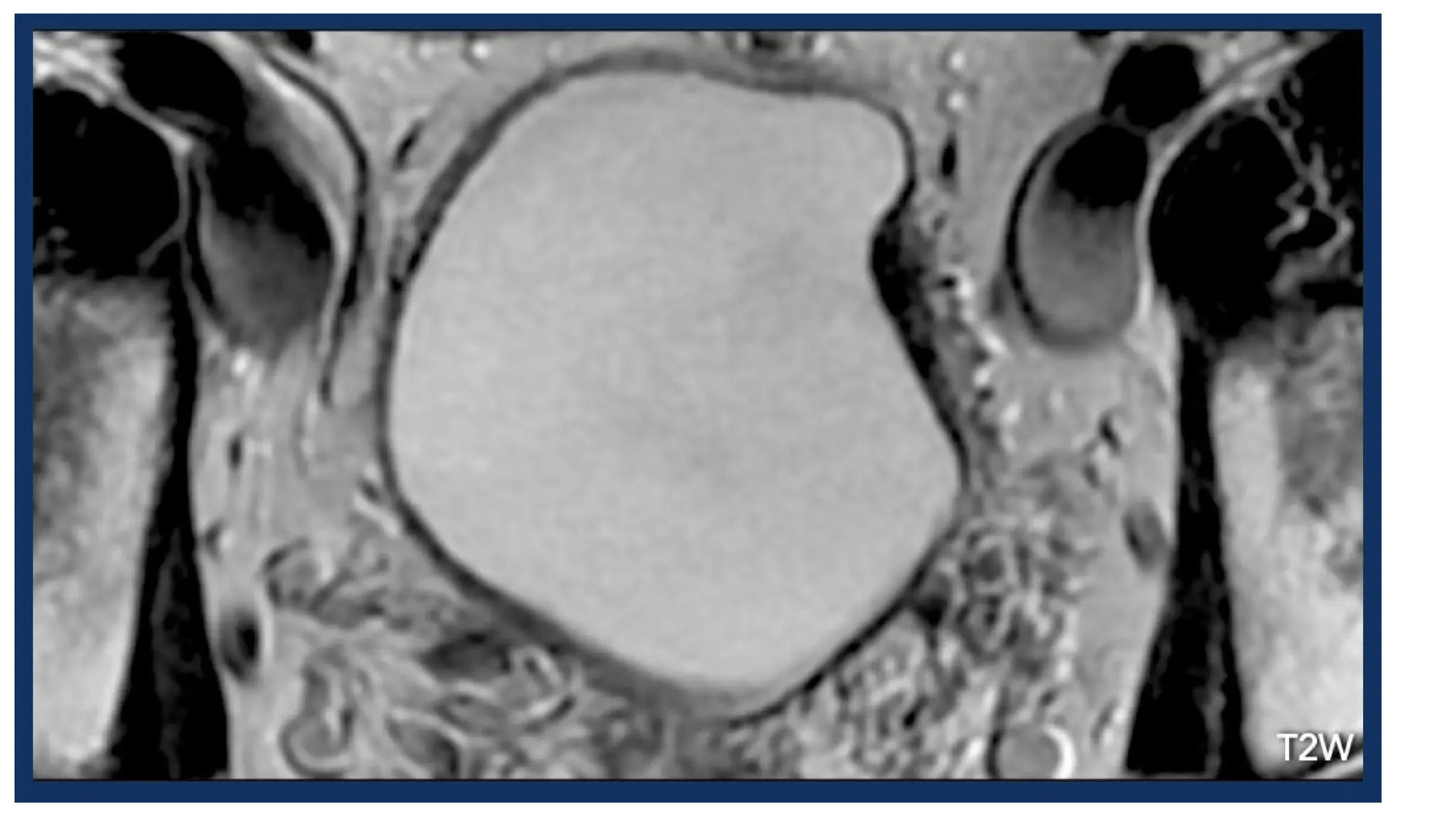 Multiparametric MRI for Bladder Cancer.pptx