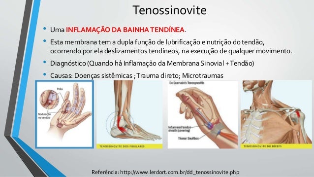 FISIOTERAPIA v: Síndrome do Túnel do Carpo; Tenossinovitev; Lesões de…