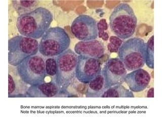 Multiple myeloma - Dr Guru | PPT