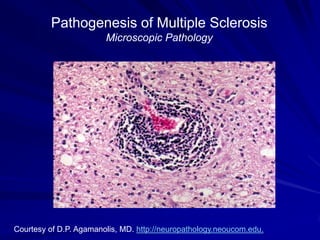 Multiple sclerosis-basic-principles-and-new-developments596 (1) | PPTX | Brain and Nervous ...