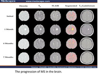 Multiple Sclerosis Recovery | PPT