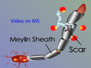 Multiple Sclerosis Recovery | PPT