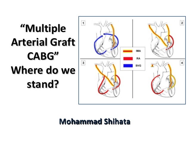 Multiple arterial graft cabg