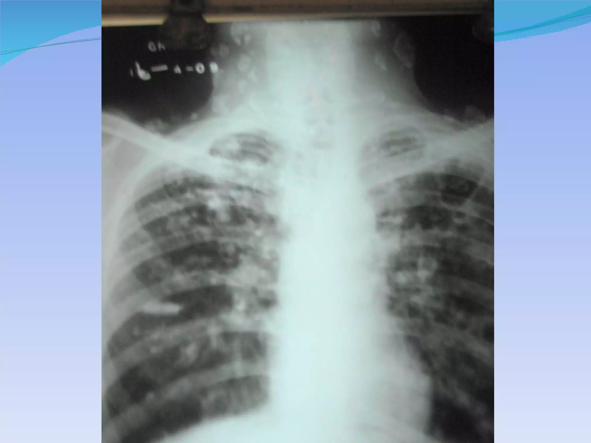 CXR: Multiple calcifications | PPT | Diseases and Conditions | Medical ...