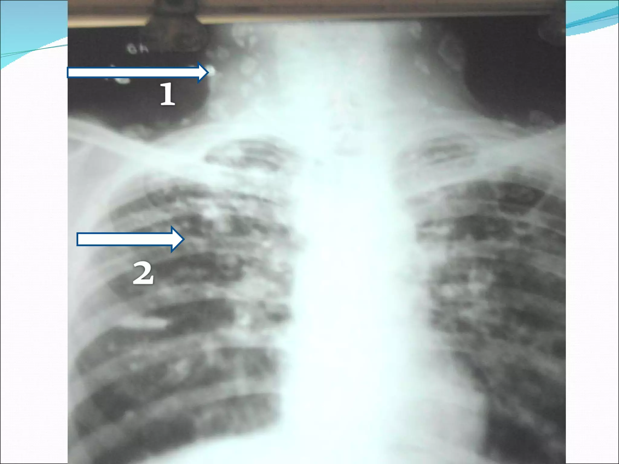 CXR: Multiple calcifications | PPT | Diseases and Conditions | Medical ...