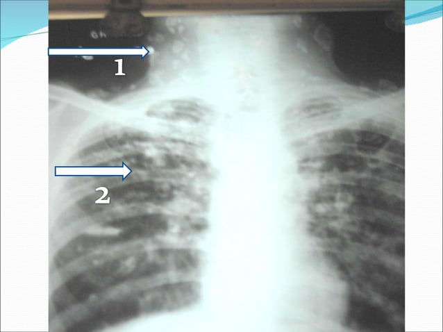 CXR: Multiple calcifications | PPT | Diseases and Conditions | Medical ...