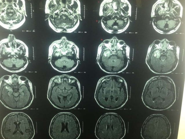 Multiple cranial nerve palsies | PPTX | Eye and Vision Conditions ...