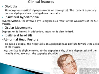 Vertical Diplopia Cranial Nerve – NMLUN