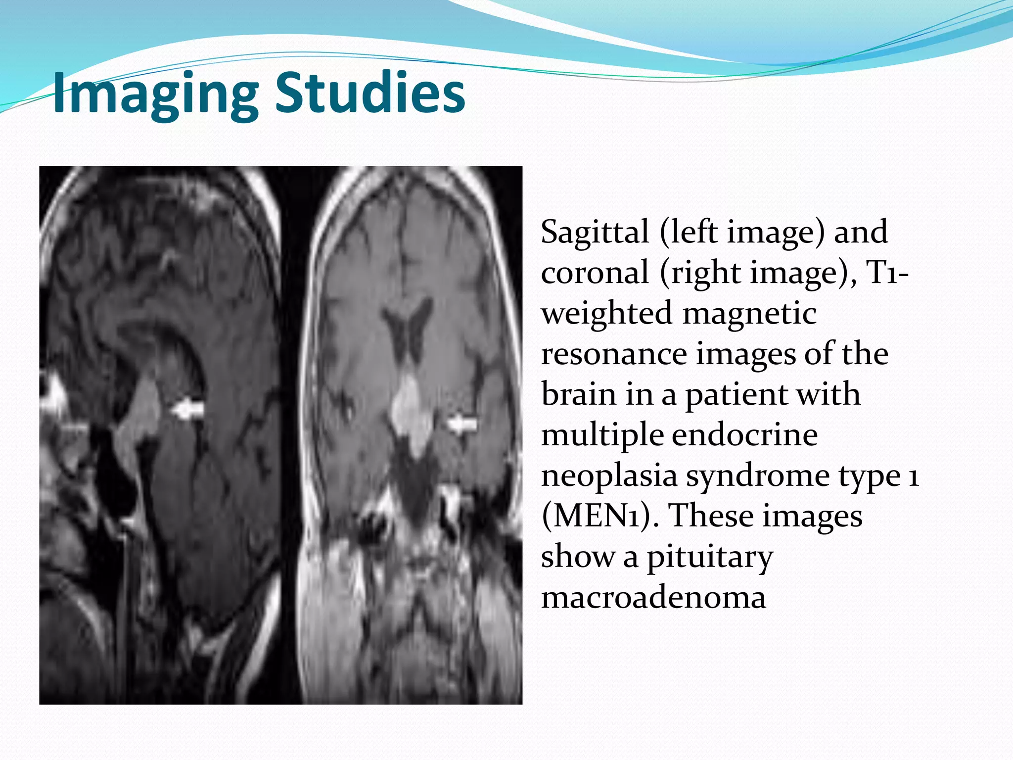 Multiple endocrine neoplasia (men) syndromes | PPTX
