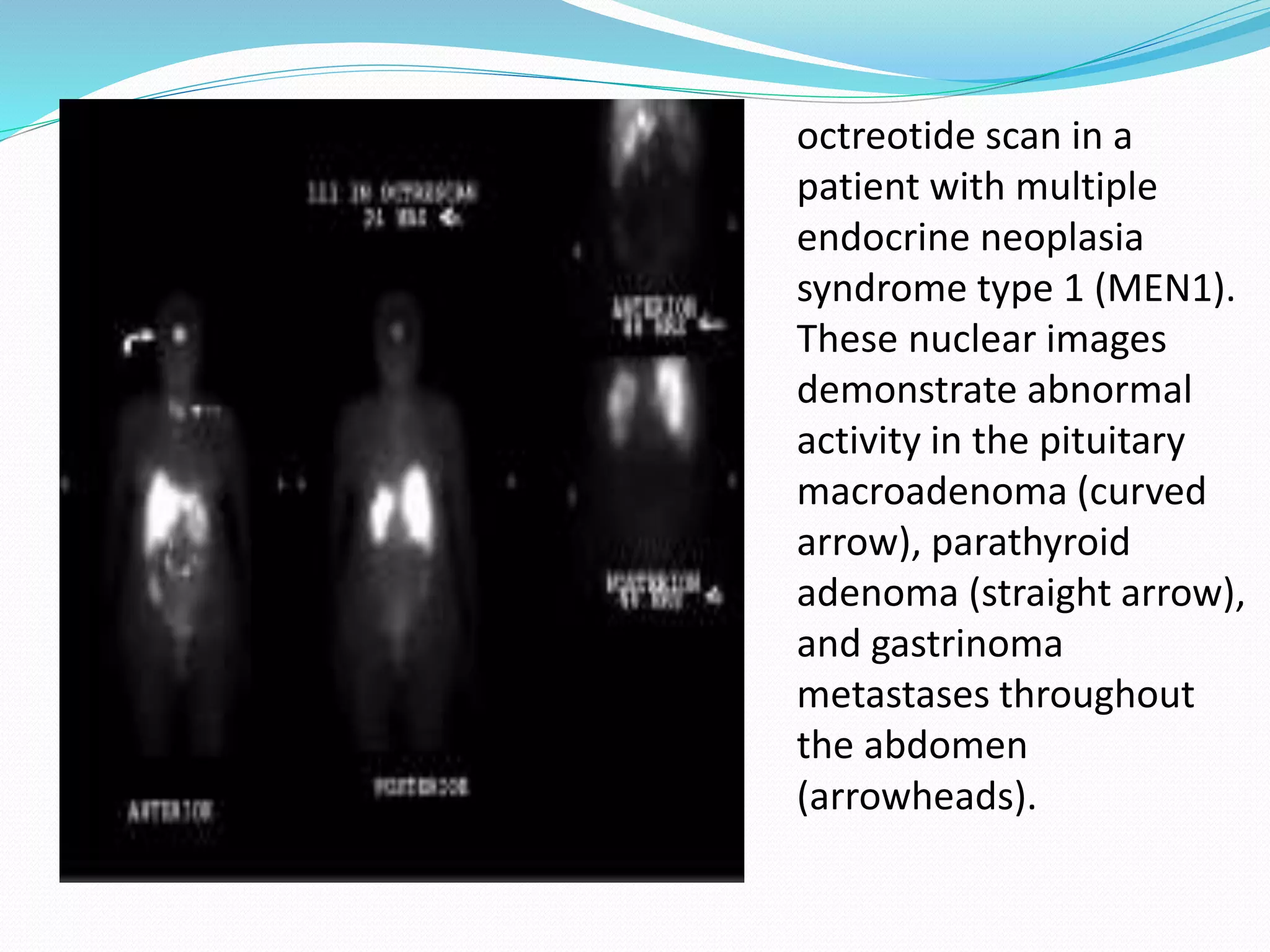 Multiple endocrine neoplasia (men) syndromes | PPTX