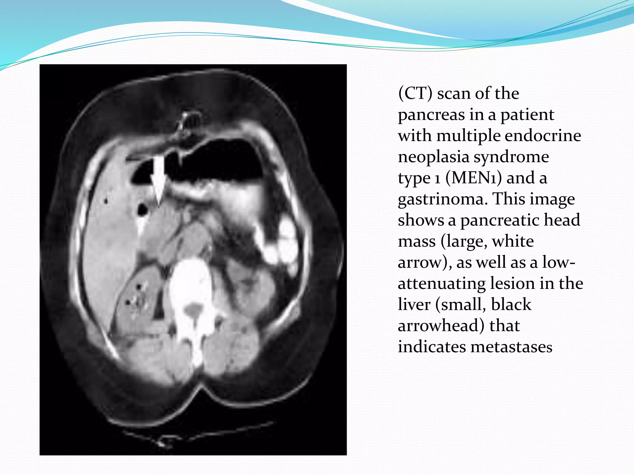 Multiple endocrine neoplasia (men) syndromes | PPTX
